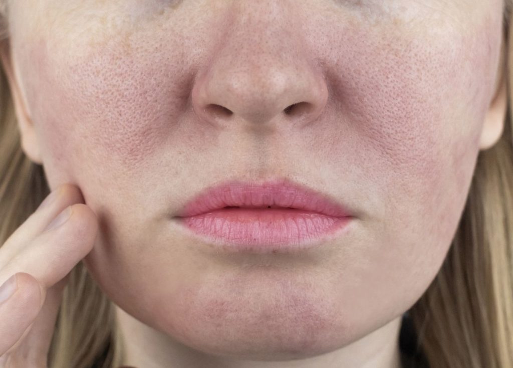 Lỗ Chân Lông To: Cách Se Khít Lỗ Chân Lông Hiệu Quả Đơn Giản | TIKI