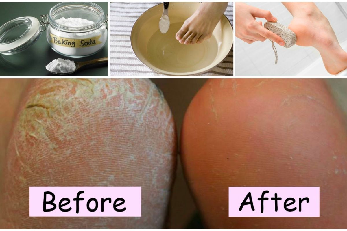 18 Cách Trị Nứt Gót Chân Tại Nhà, Hiệu Quả, Đơn Giản | TIKI